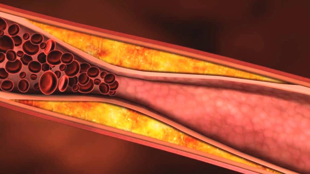 Hypertension Artérielle (Tension Élevée) : Définition, 8 Symptômes & 7 ...