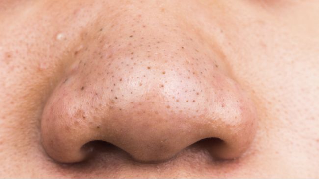 Acné : Définition, Différents Types + 14 Astuces Pour Lutter Contre l'Acné