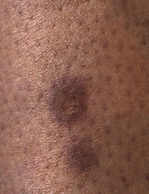 Diabète Type 2 (DNID) : Explication, 7 Symptômes, 1 Cause + 29 Conseils